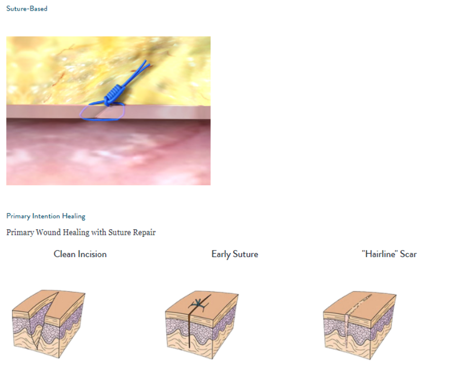 Perclose Proglide Suture-Mediated Closure System Overview | Abbott